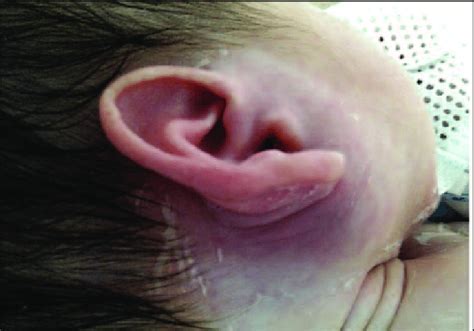 Earlobe Abscess Abscess Under Ear Lobe Guesture 2024 - Auto News