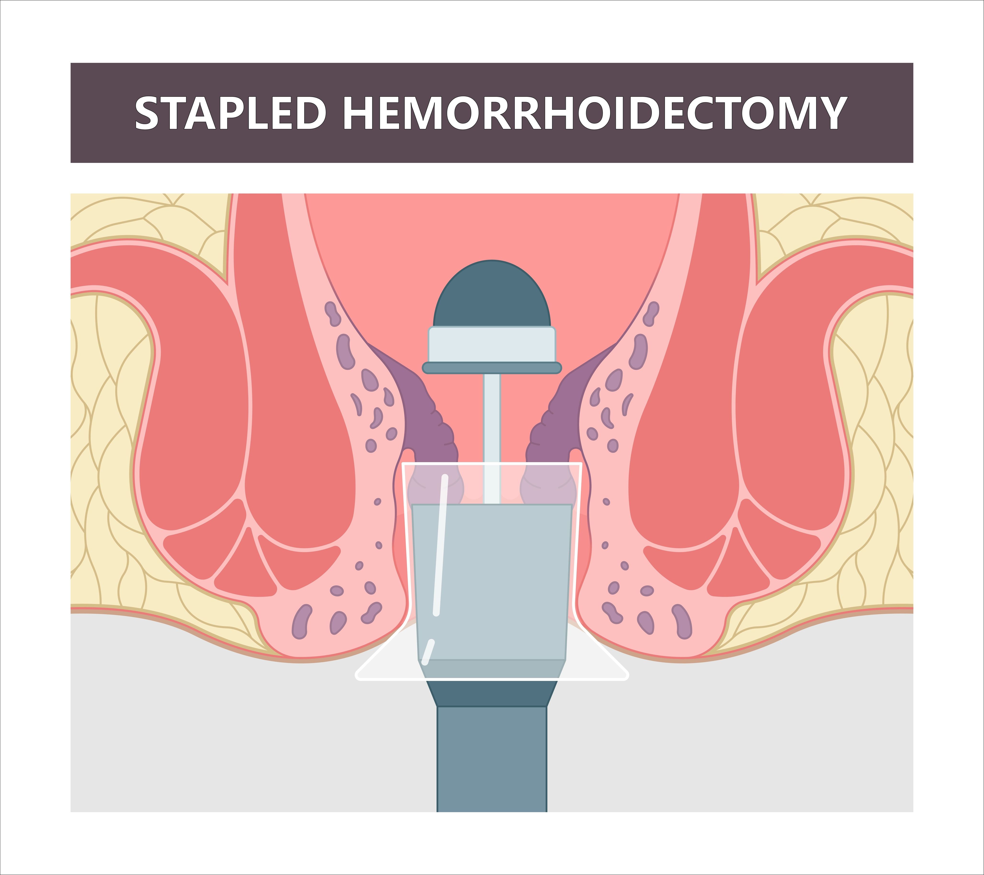 Hemorrhoid Grading System: Grade 1 to 4 Explained - Auto News