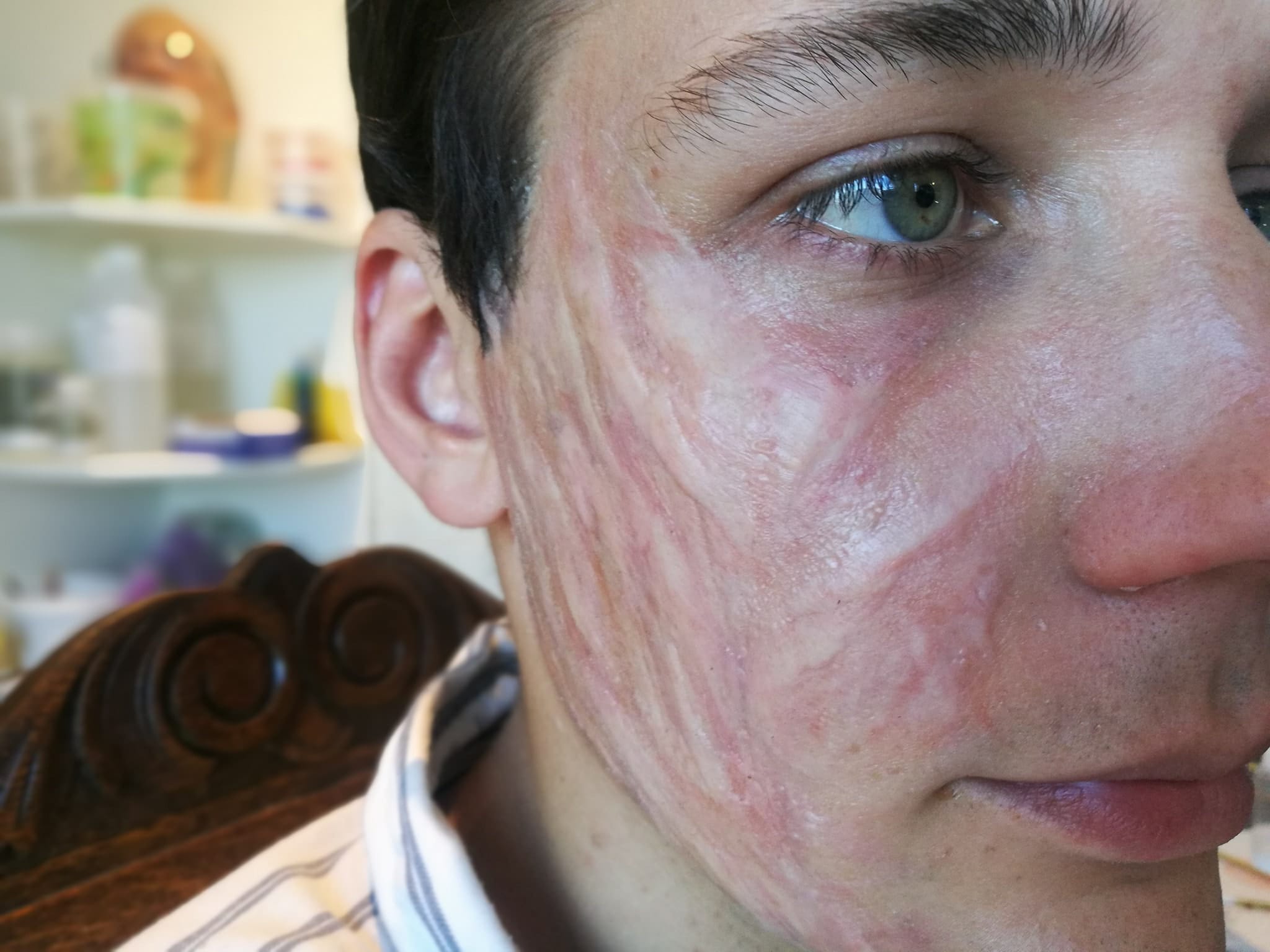 wounds that never fully heal, only dries, then scabs peel off on its ...